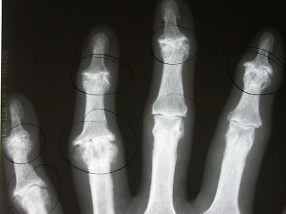 Hand: Arthrose / Roland-Klinik