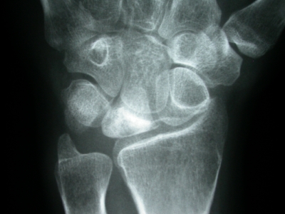 Hand: Lunatummalazie / Roland-Klinik